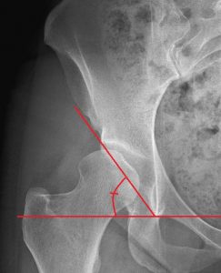 Hip Dysplasia: What’s With All the Angles? - Miles4Hips