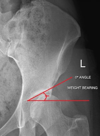 Hip Dysplasia: What’s With All the Angles? - Miles4Hips