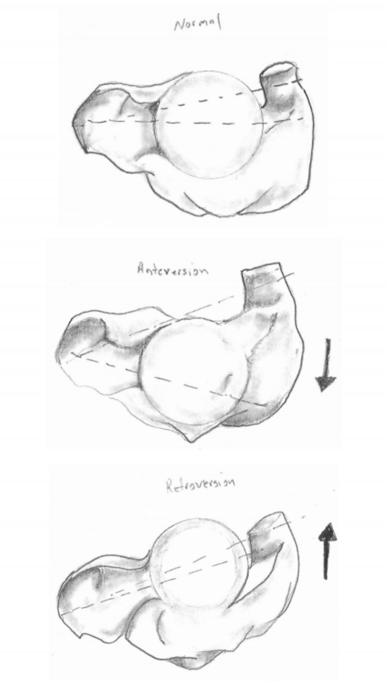 Hip Dysplasia: What’s With All the Angles? - Miles4Hips