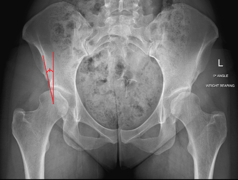What’s With All The Angles? Hip Dysplasia X-Ray Measurements - Miles4Hips